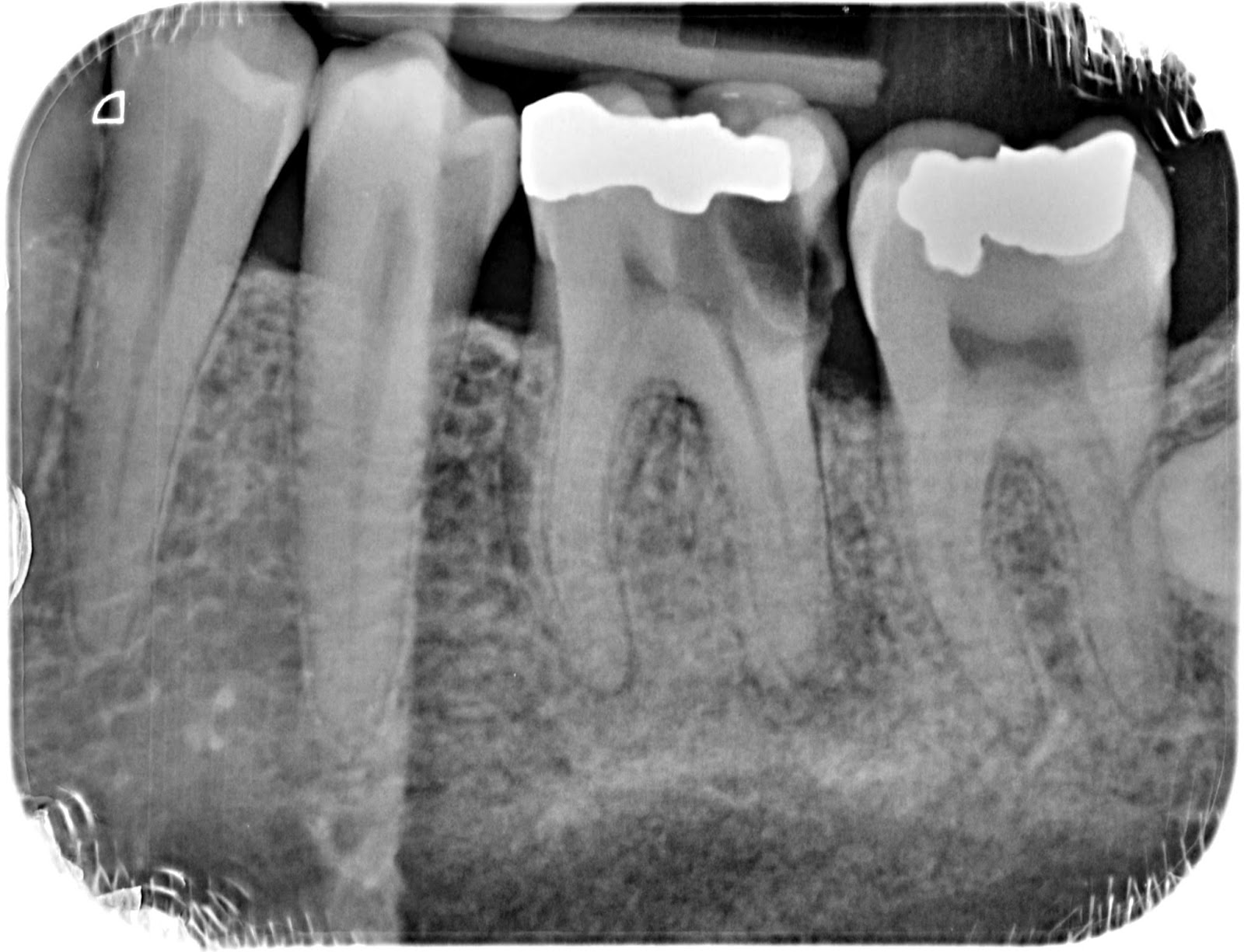 Caso clínico Master: Entomolaris On Fire