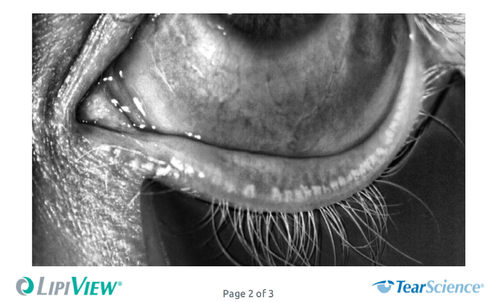 Diagnosing Meibomian Gland Disease - Eyedolatry