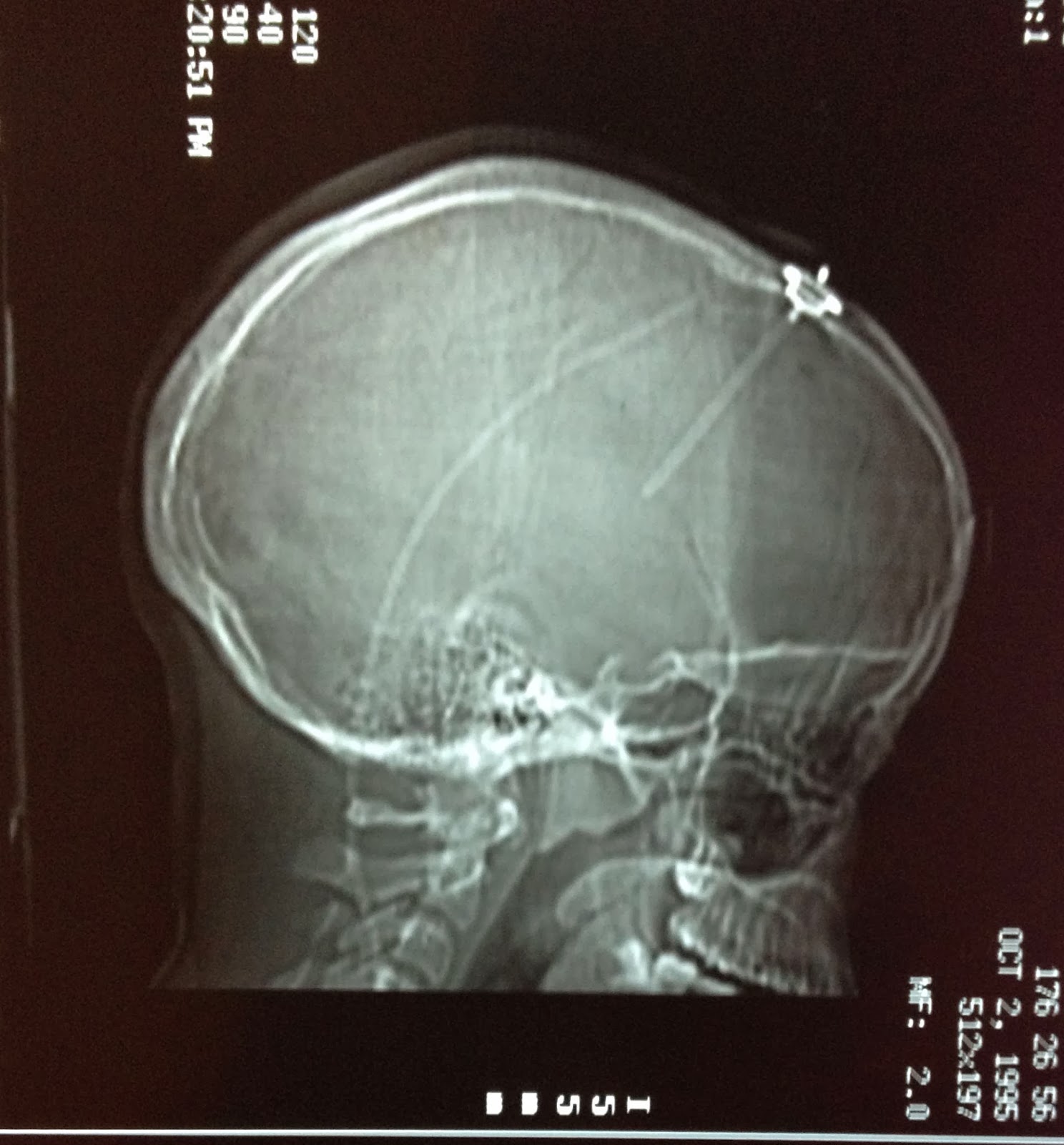 Shunt Chronicles: February 2014