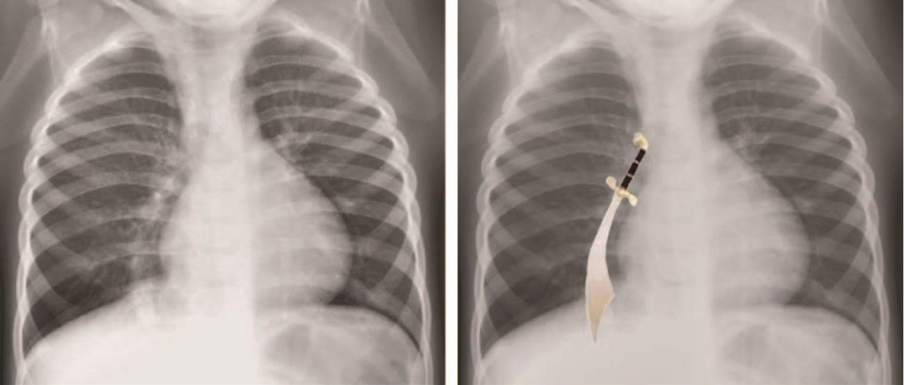 Chest Medicine Made Easy-Dr Deepu: Classical X Ray Signs in congenital ...