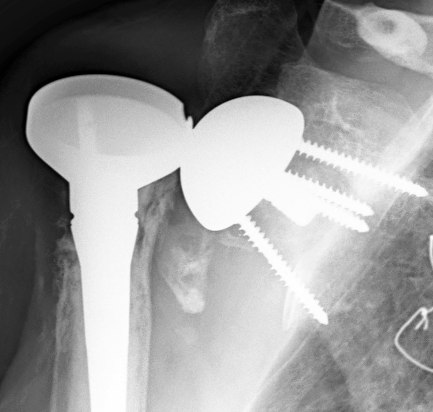 UW Shoulder and Elbow Academy: Reverse total shoulder joint replacement ...