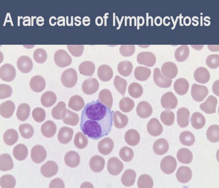 Medical Laboratory and Biomedical Science: A Rare Cause of Lymphocytosis