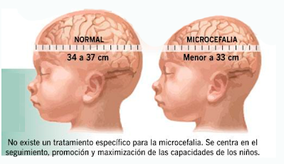 Microcefalia