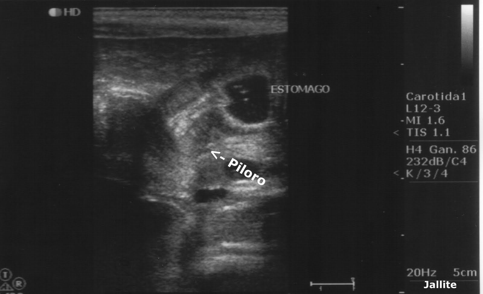 Estenosis Hipertrofica Piloro