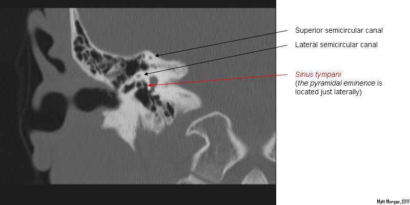 Skull and Spine: The Pit and the Pyramid