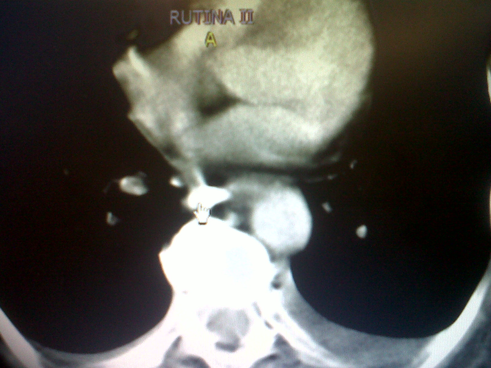Endoscopia y Cirugía Digestiva: PACIENTE CON DISFAGIA Y LESION ...