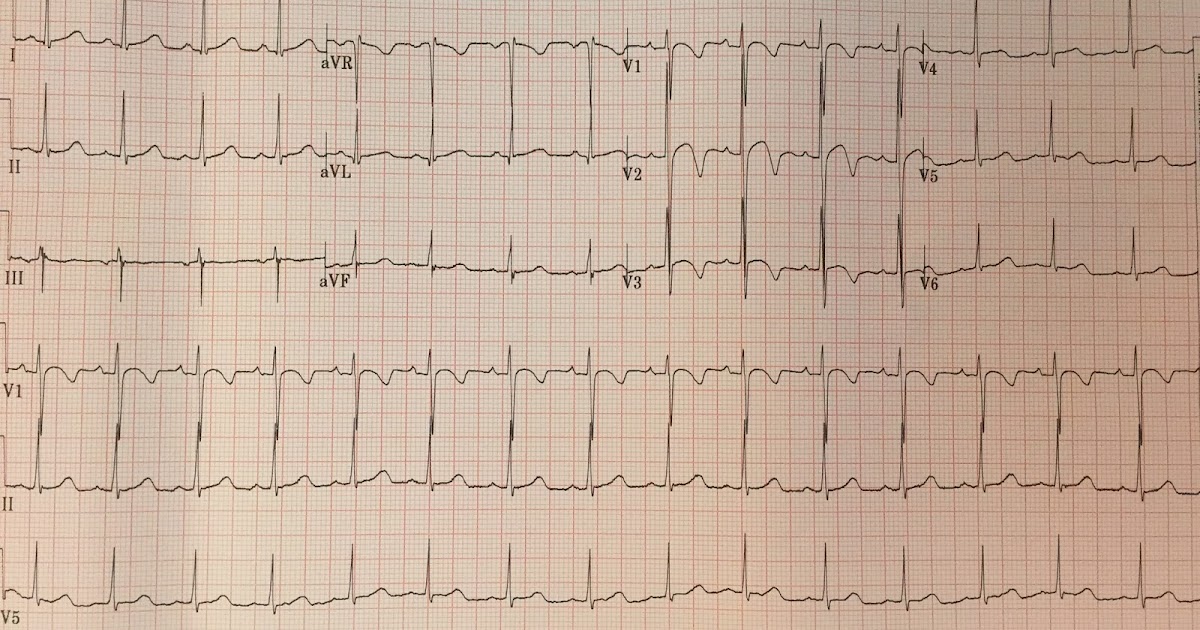 Dr. Smith's ECG Blog: 8 year-old with report of "syncope and an ...