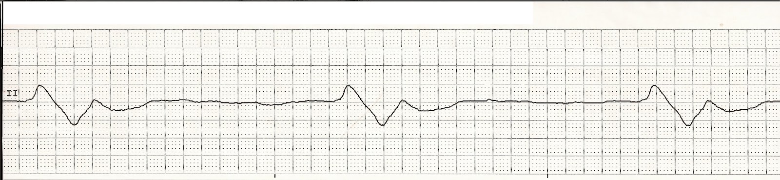 Float Nurse: EKG Rhythm Strip Quiz 41