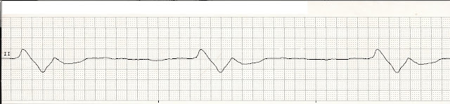 EKG Rhythm Strip Quiz 41