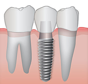Removable Partial Denture: Implants