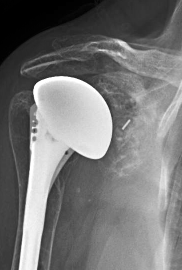 Shoulder Arthritis / Rotator Cuff Tears / Shoulder Pain : Total ...