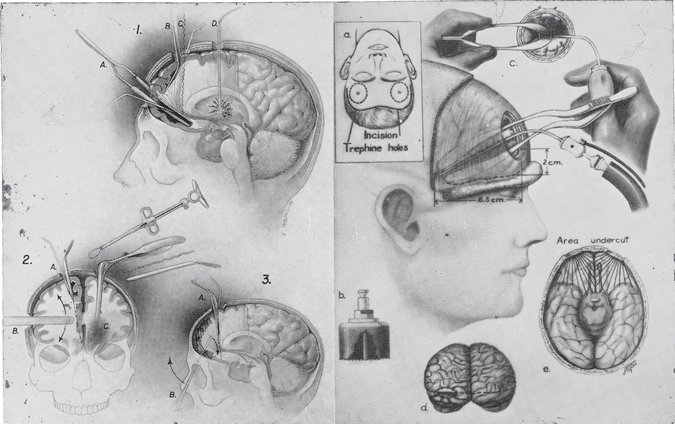 Our Parkinson's Place: The Brain That Couldn’t Remember