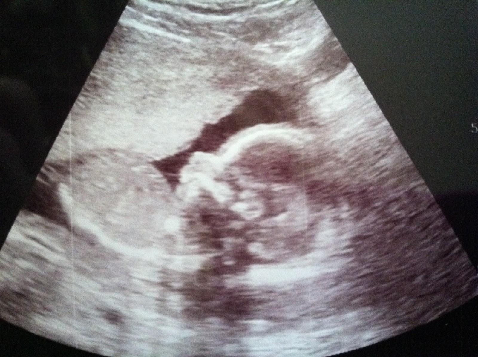 We're Having a Baby!: 18 Week Ultrasound Pictures