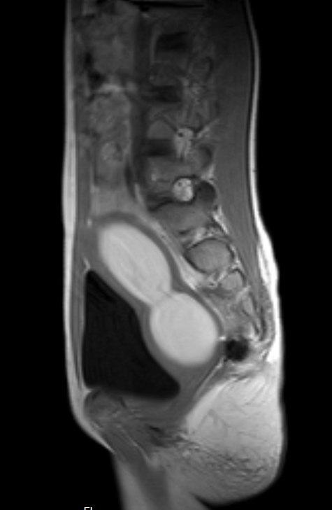 Haematometra & Hematosalpix-MRI - Sumer's Radiology Blog