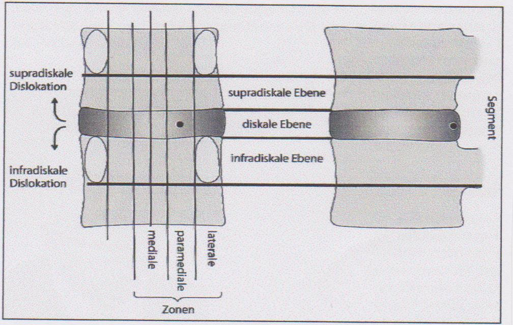 Medical Informations: Minimally invasive spinal disc treatment