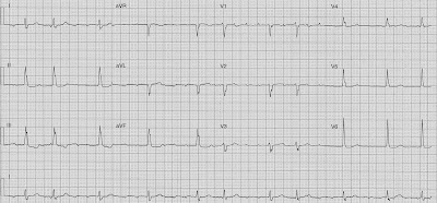 ECG of the Week: ECG of the Week - 2nd December 2013 - Interpretation
