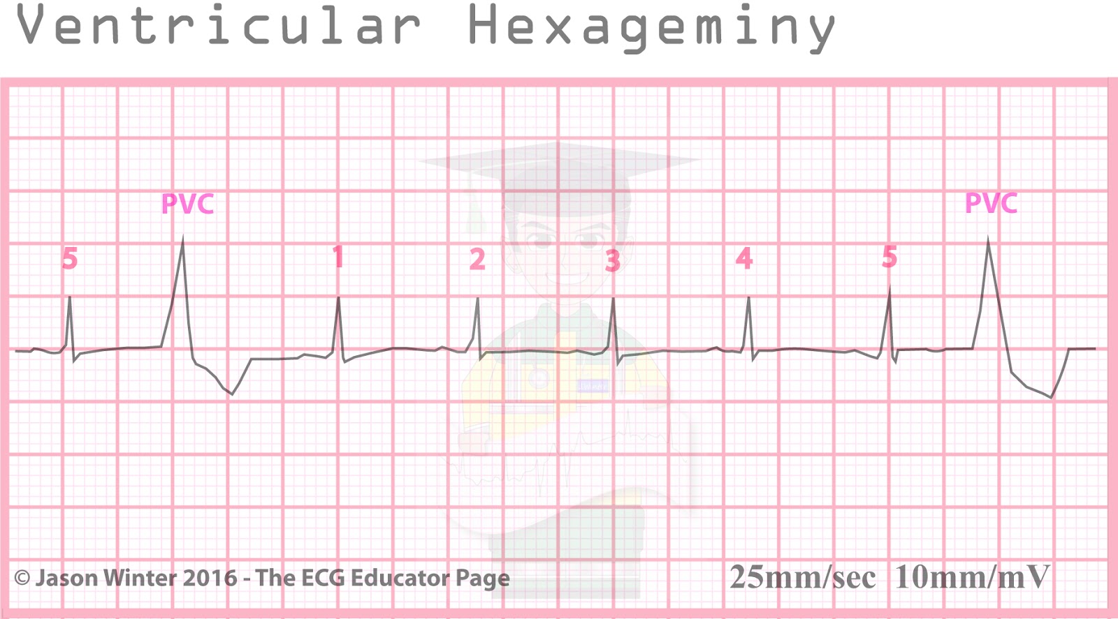 ECG Educator Blog : Ventricular Ectopics