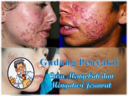 Cara Mengobati dan Mengatasi Jerawat | Gudang Penyakit