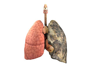 Anthracosis - Definition, Symptoms, Causes, Treatment - Health Care ...