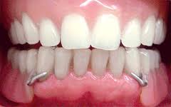 Atelier Dental, Dr Alfredo Aleman Neto, Reabilitação Oral no Bessa ...