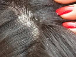 Dandruff woes- How to treat persistent and stubborn dandruff. | Lets go ...