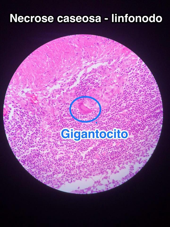 HISTOLOGIA90: TIPOS DE NECROSE