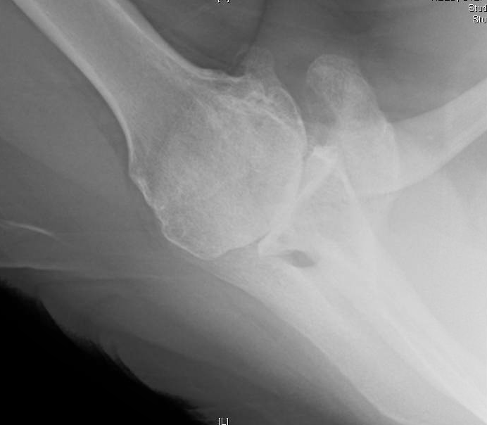 Shoulder Arthritis / Rotator Cuff Tears / Shoulder Pain : Preoperative ...