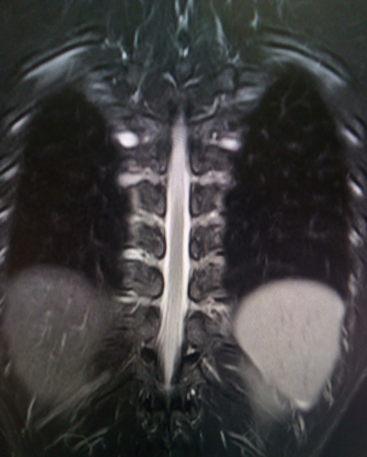 Chronic inflammatory demyelinating polyradiculoneuropathy (CIDP): MRI ...