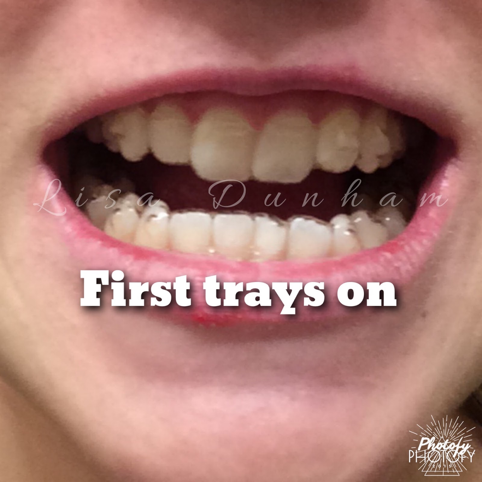 Dunham Wellness: My First Invisalign Update of many, Tray 2 of 26!!