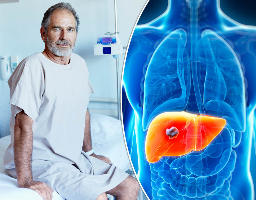 Liver Cancer Symptoms In Males Canceroz