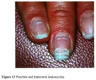 Nail Diseases: Leukonychia
