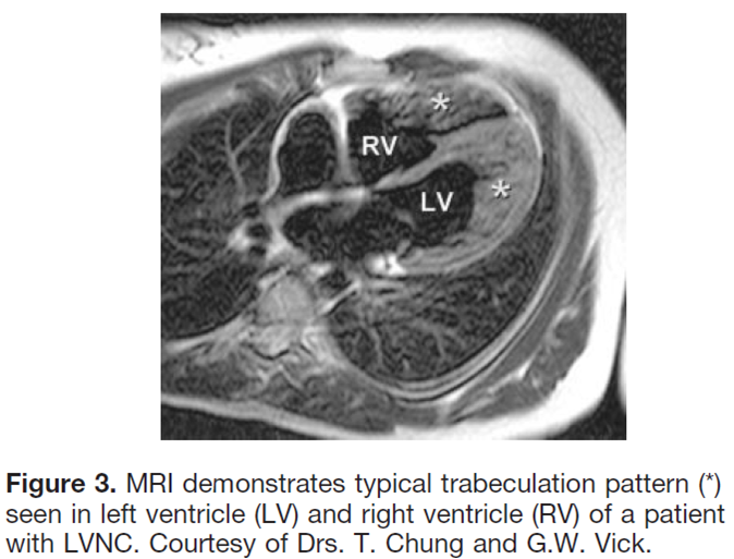 What Is Lv In Cardiology | Paul Smith