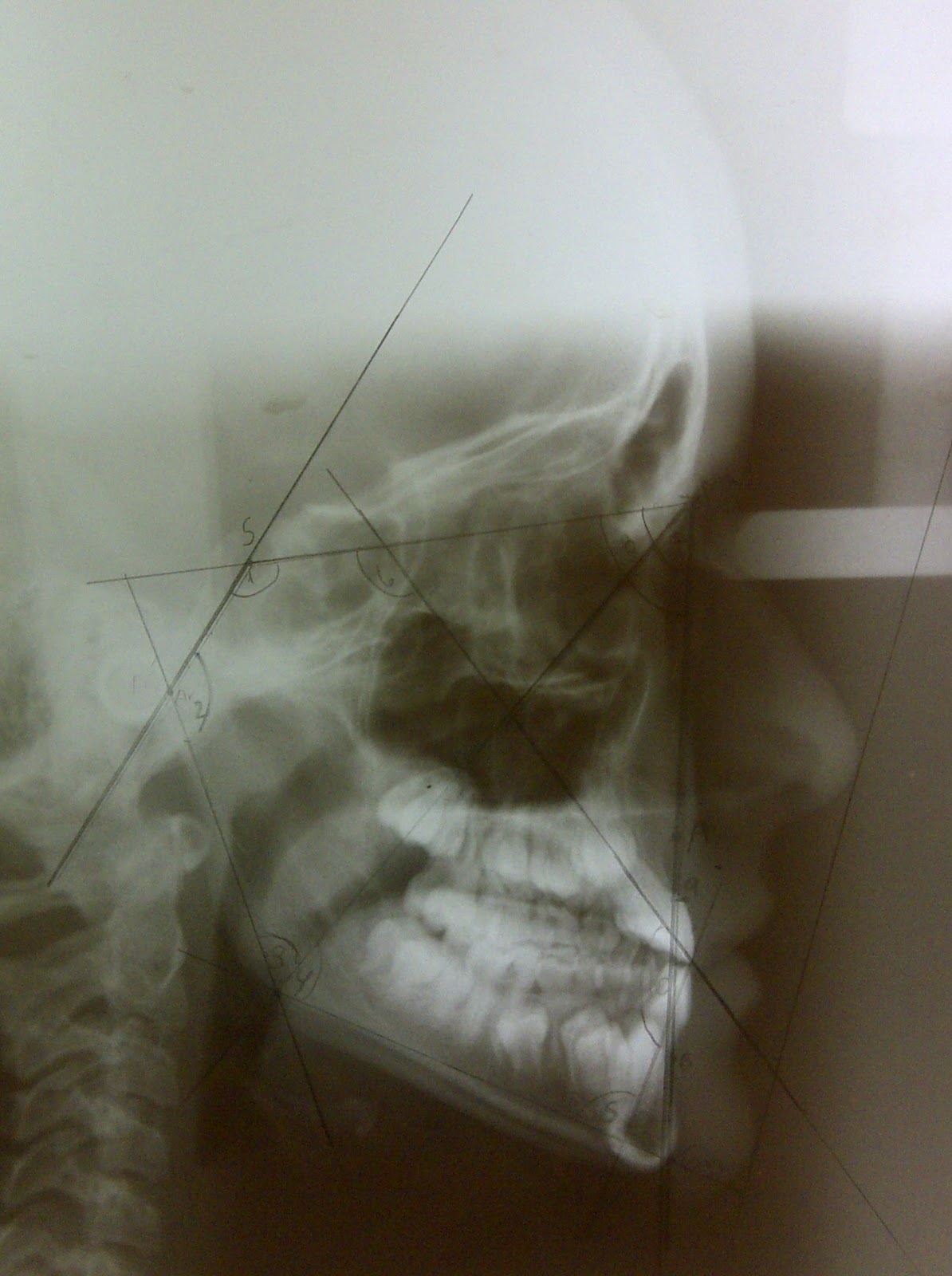 Casos Clinicos Odontologicos: ORTOPEDIA DENTAL