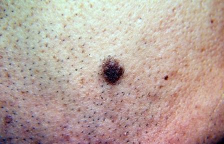 The Nevocellular Nevi (Moles) - Beauty And Skin