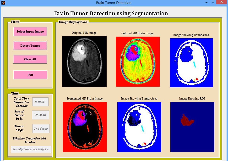 Brain Tumor Detection Using Matlab Project With Source Code ~ Engineering Projects