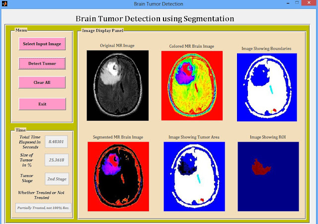 Brain Tumor Detection Using Matlab Project With Source Code ~ ENGINEERING PROJECTS