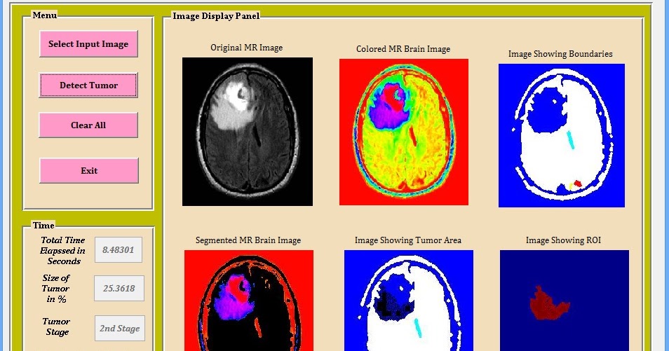 Brain Tumor Detection Using Matlab Project With Source Code ~ ENGINEERING PROJECTS