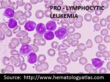 Lab Atlas: Pro Lymphocytic Leukemia