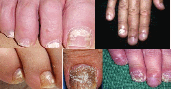 Onicomicose? Mais o que é isso? - Geri e Derme Beauty