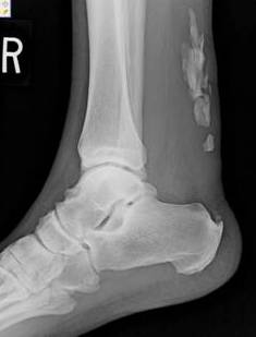 Tendoachilles Calcification-Plain Film - Sumer's Radiology Blog