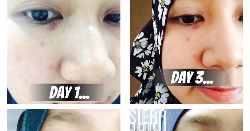 Parut Pada Muka Hilang dalam Masa 7 hari sahaja!