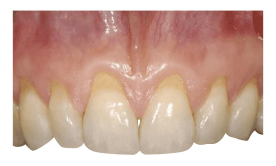 Gengive che si "ritirano": scopriamo di più!