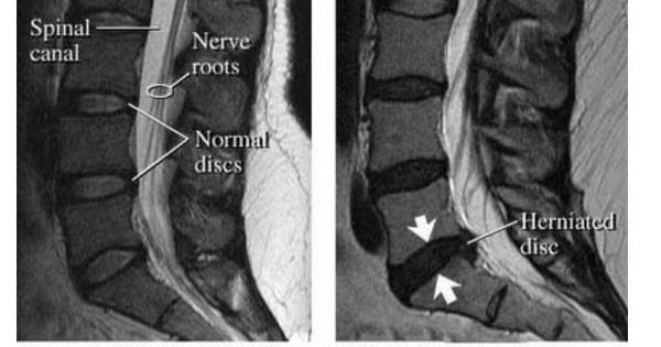 Cara Selamat Atasi Slipped Disc Tanpa Pain Killer Untuk Ibu Menyusu ...