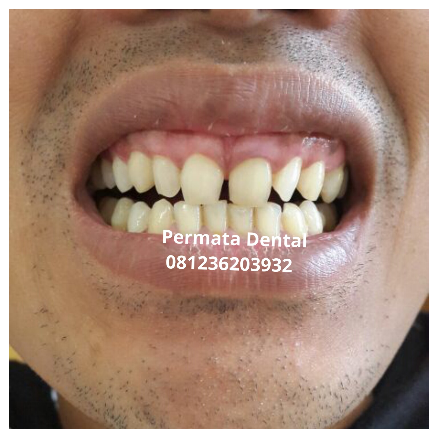 DOKTER GIGI BALI: Veneer Gigi | Samsung Gigi