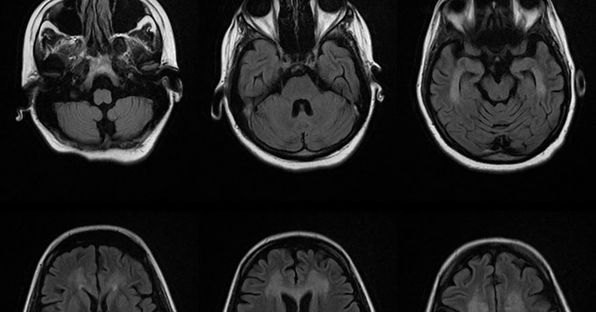 Dr Balaji Anvekar FRCR: Vit B12 deficiency MRI brain findings