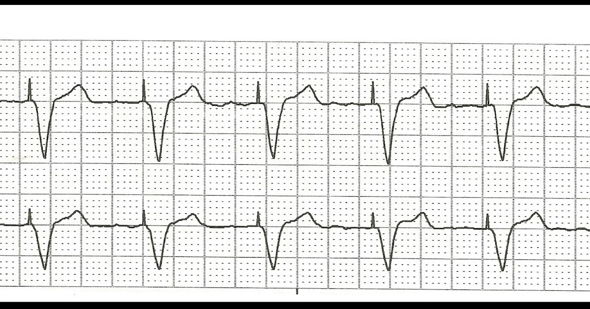 Float Nurse: EKG Rhythm Strip Quiz 146