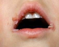 Photos of Warts on Face ~ How To Remove Moles, Warts, Skin Tags Safely