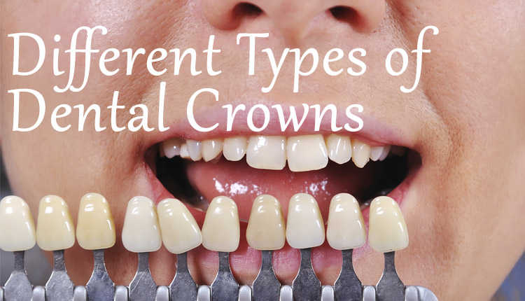 Dental Crowns Different Types