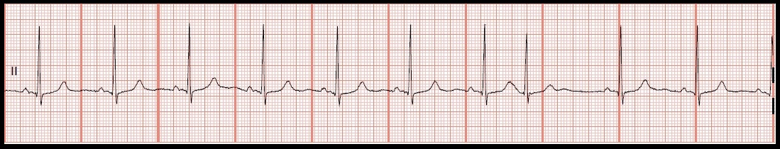 Practice EKG Rhythm Strips 139