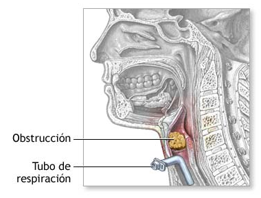 Enfermeria: TRAQUEOTOMÍA